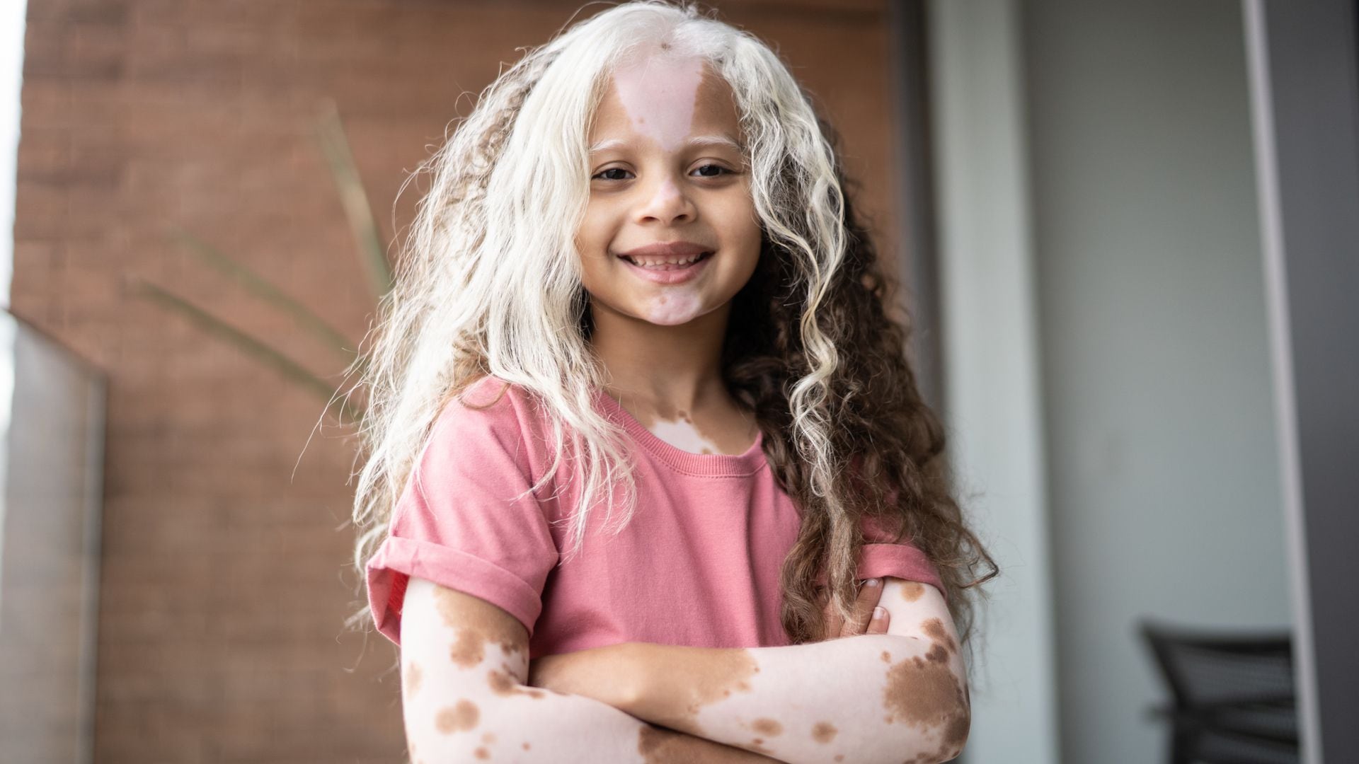 Día Mundial Del Vitiligo Qué Es A Quiénes Afecta Y Cómo Se Trata Infobae